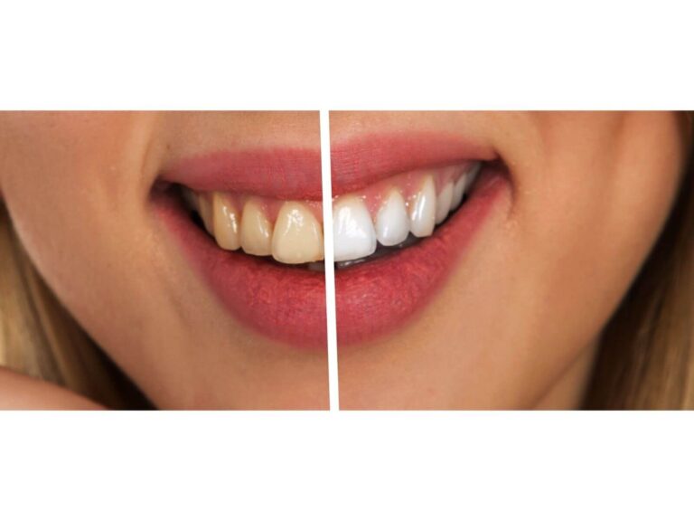 Causes & Prevention of Yellow Teeth at Sinton Pediatric Dentist